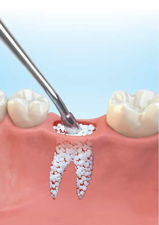 Dental Bone Grafting Pittsburgh- Kail and Moore Oral Surgery